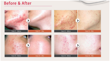 Aesthetic Medicine - Agnes offers solution for acne
