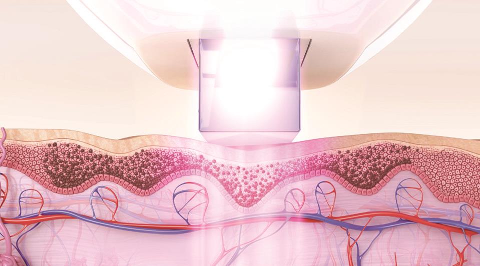 Aesthetic Medicine - Introducing the TriBella treatment from Venus Concept