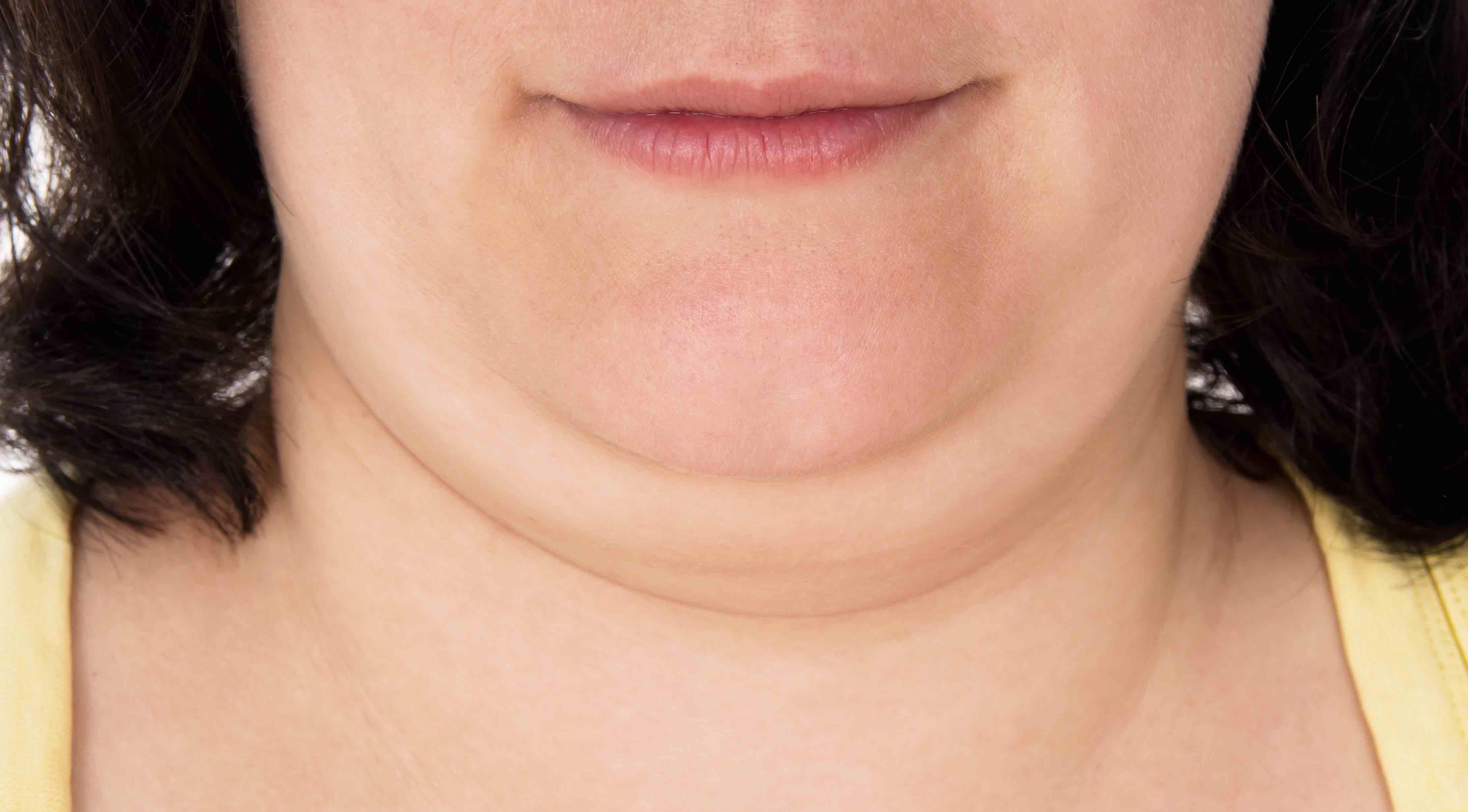 Aesthetic Medicine - Survey reveals impact of double chin on self ...