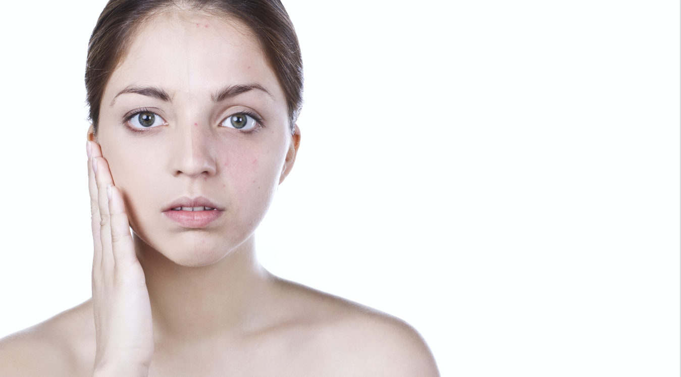 Study examines the role of anxiety in stress-related skin disease