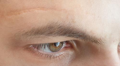 Aesthetic Medicine - Study examines scar tissue improvement with ...