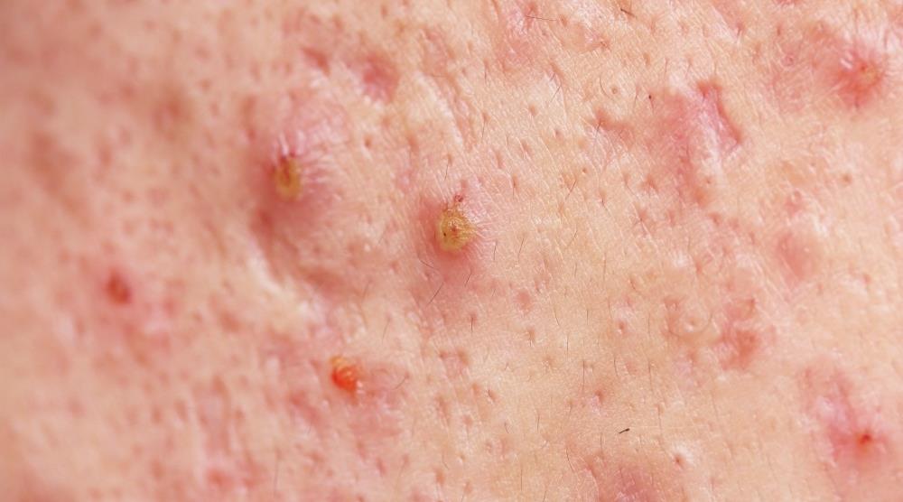 Aesthetic Medicine - New drug application Seysara is FDA approved